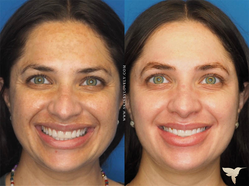 Cosmelan Depigmentation Peel | Chemical Peel | CA, OR & WA