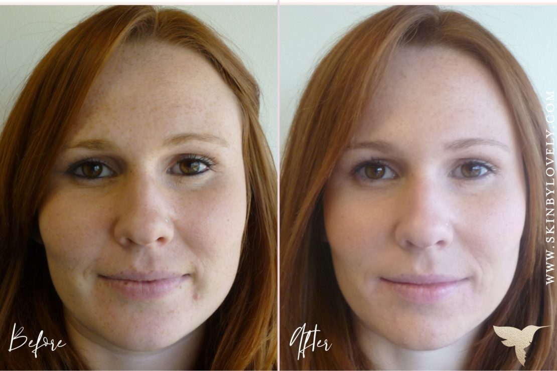 VI Peel Chemical Peel | CA, OR & WA | Skin by Lovely