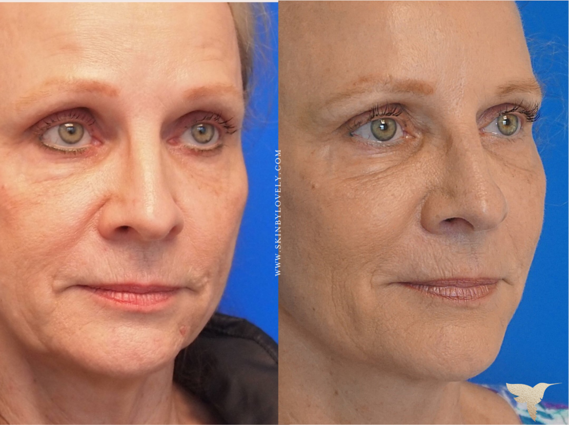 Cheek Fillers: Juvederm Voluma, Restylane Lyft & Sculptra - Skin by Lovely
