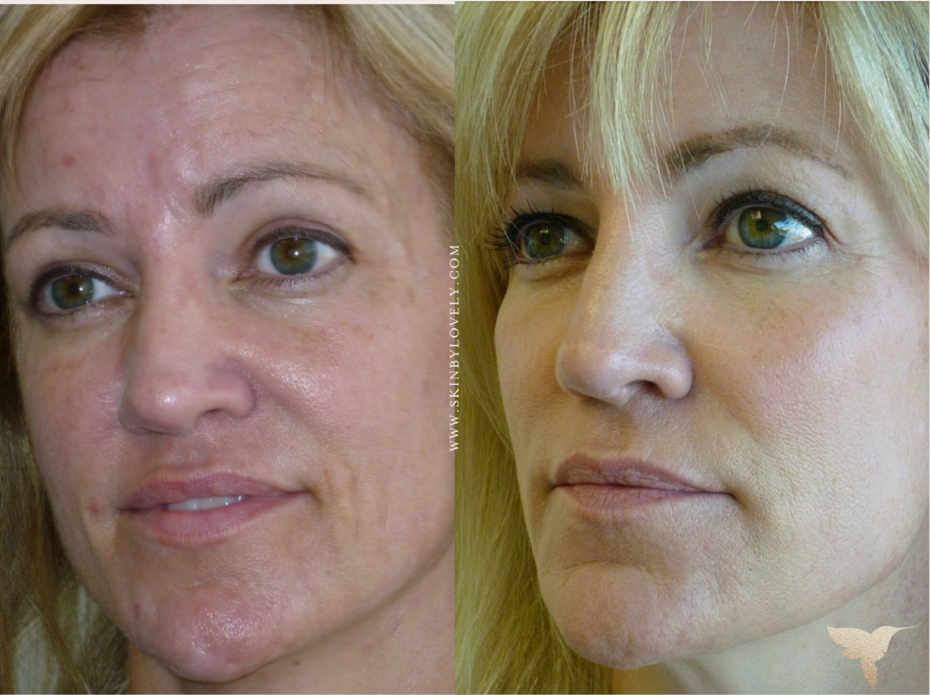 Nonsurgical Cheek Enhancements in OR, WA, and CA