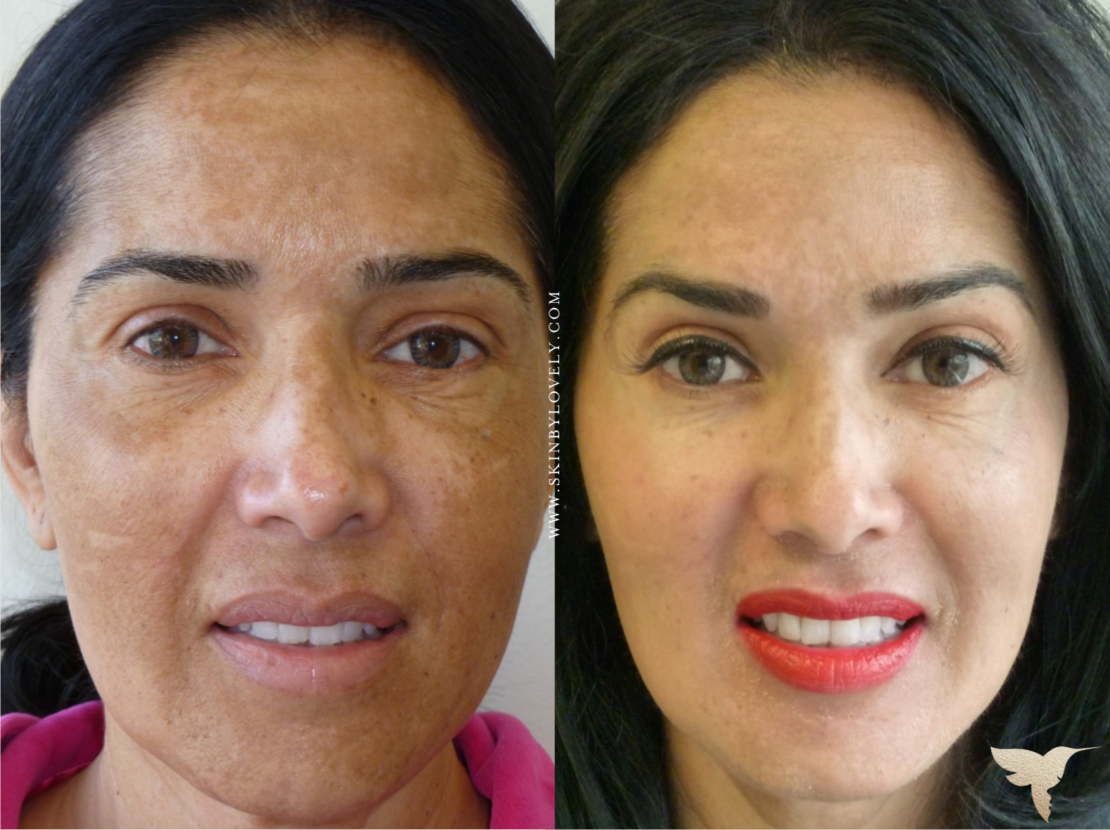 Cosmelan Depigmentation Peel | Chemical Peel | CA, OR & WA