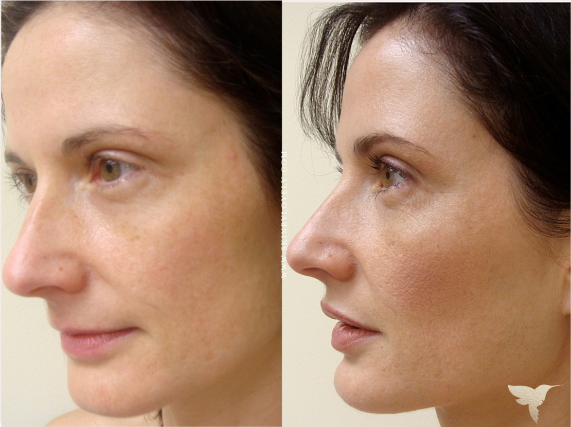 Nonsurgical Cheek Enhancements in OR, WA, and CA