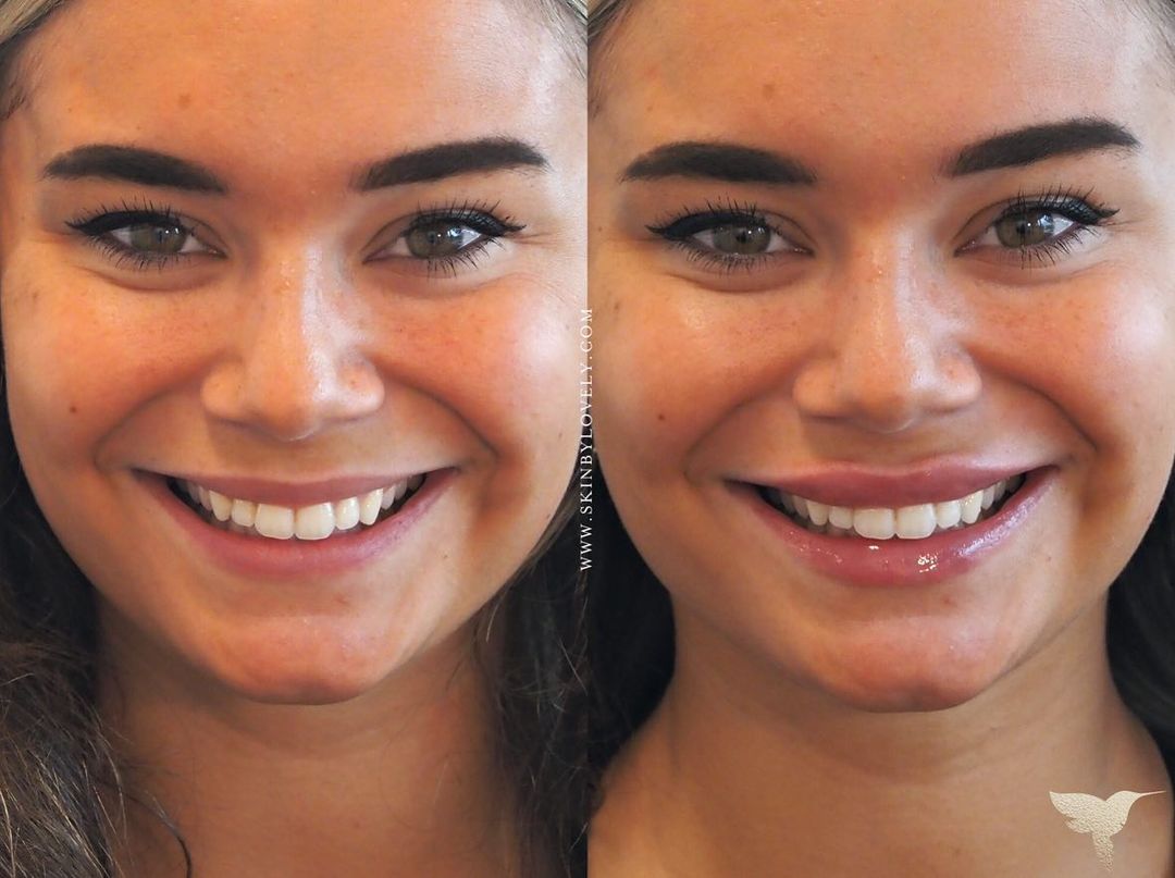 Dermal Fillers in OR, WA, & CA | Skin by Lovely