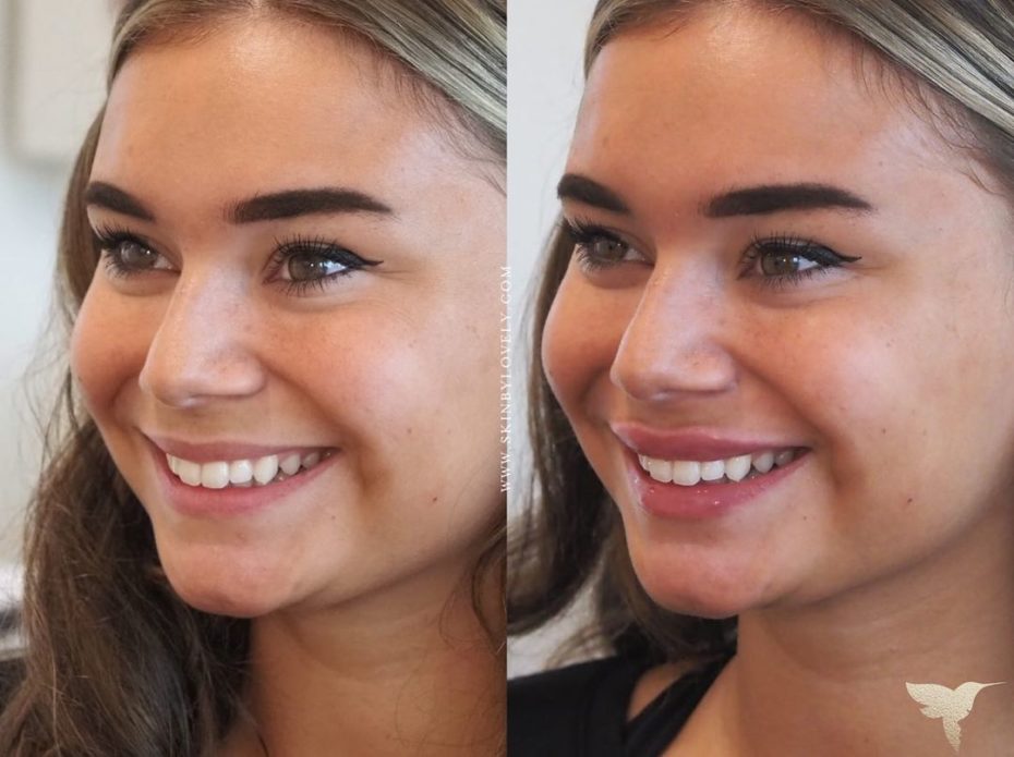 Dermal Fillers in OR, WA, & CA | Skin by Lovely