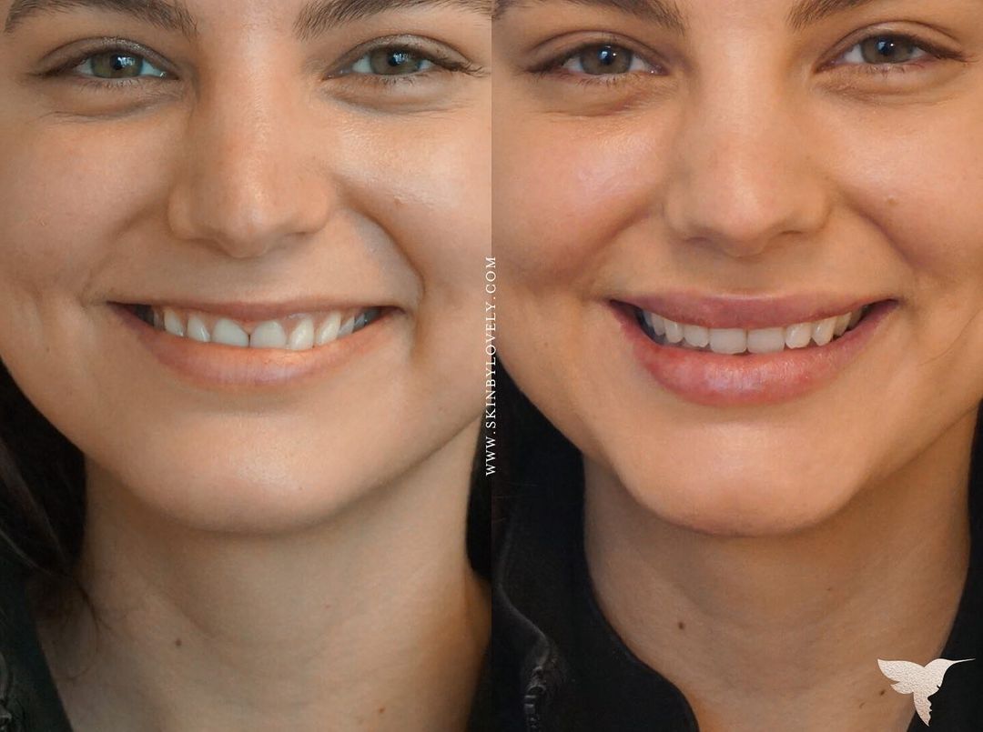 Dermal Fillers in OR, WA, & CA | Skin by Lovely