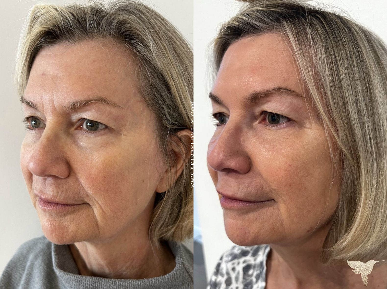 Platelet Rich Fibrin (PRF) Skin Rejuvenation Treatments