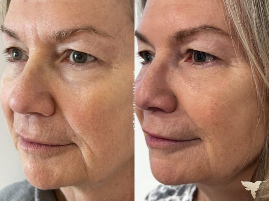 Platelet Rich Fibrin (PRF) Skin Rejuvenation Treatments