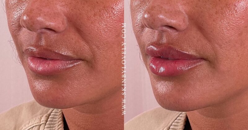 Lip Filler Results: What To Expect Day by Day